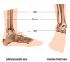 발목 골절fracture Of Ankle 발목이 비틀리면서 발목 뼈가 부러졌어요 네이버 블로그